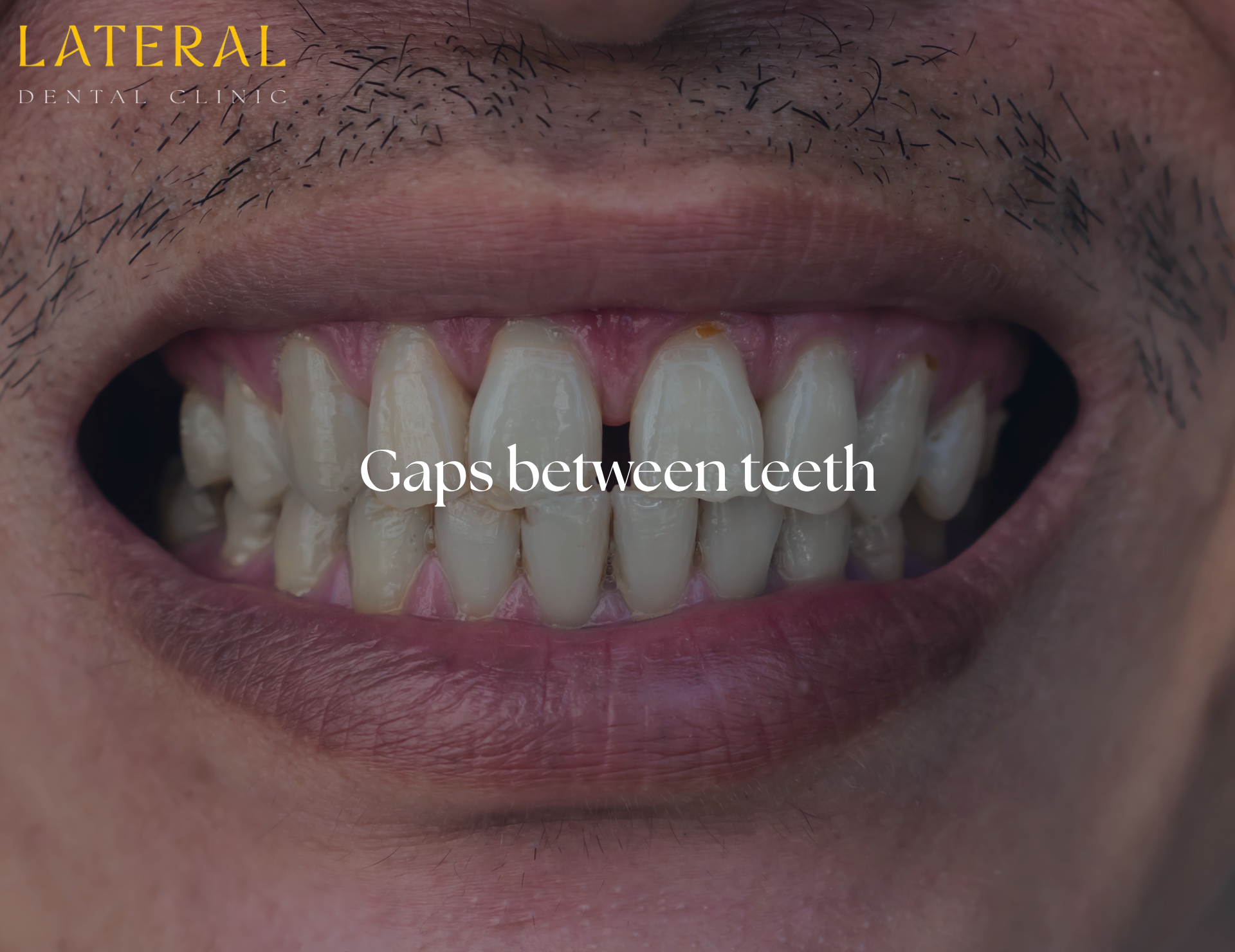 Gap Between Teeth | Causes, Fixes & Invisalign Options