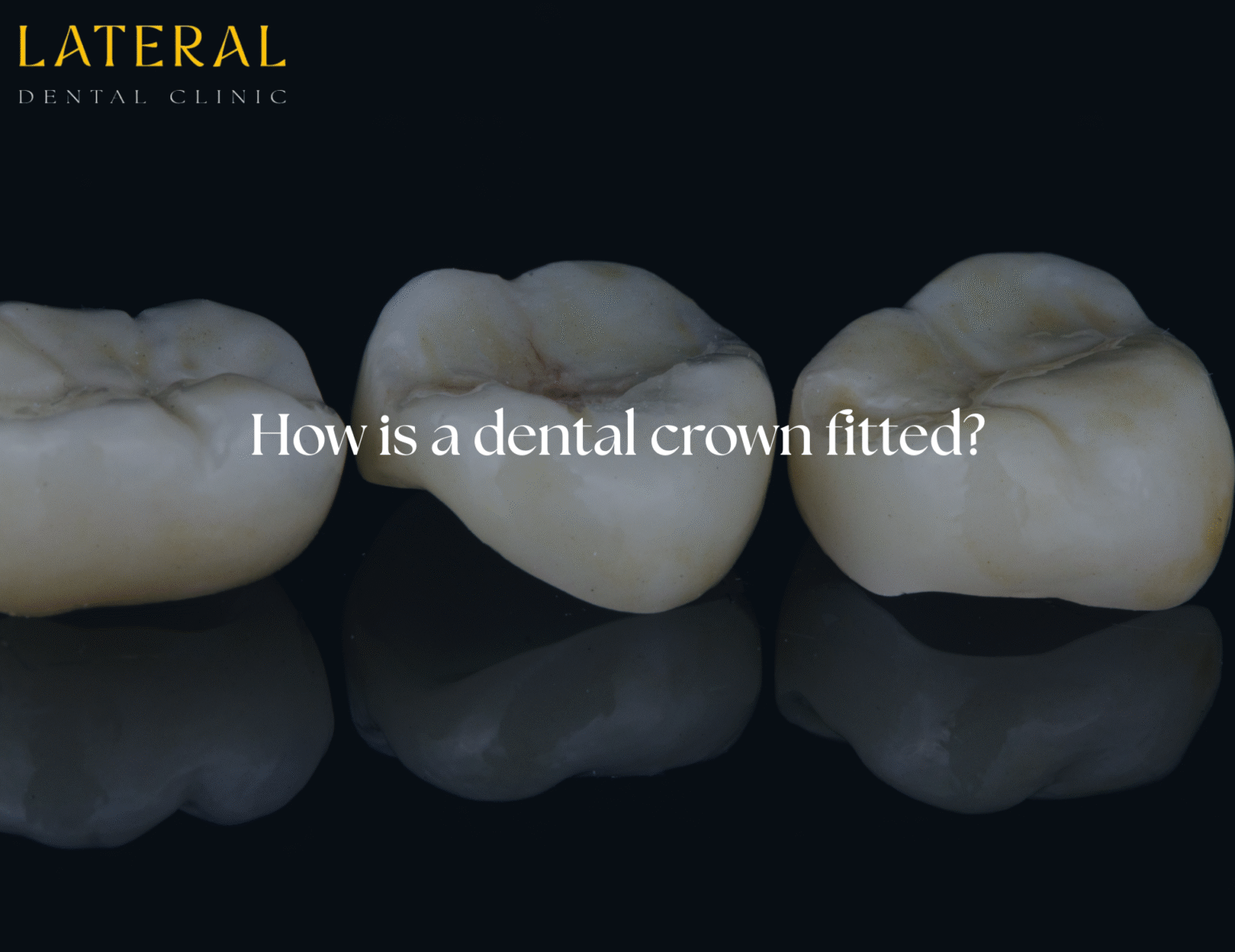 How Is a Dental Crown Fitted? Step-by-Step Guide