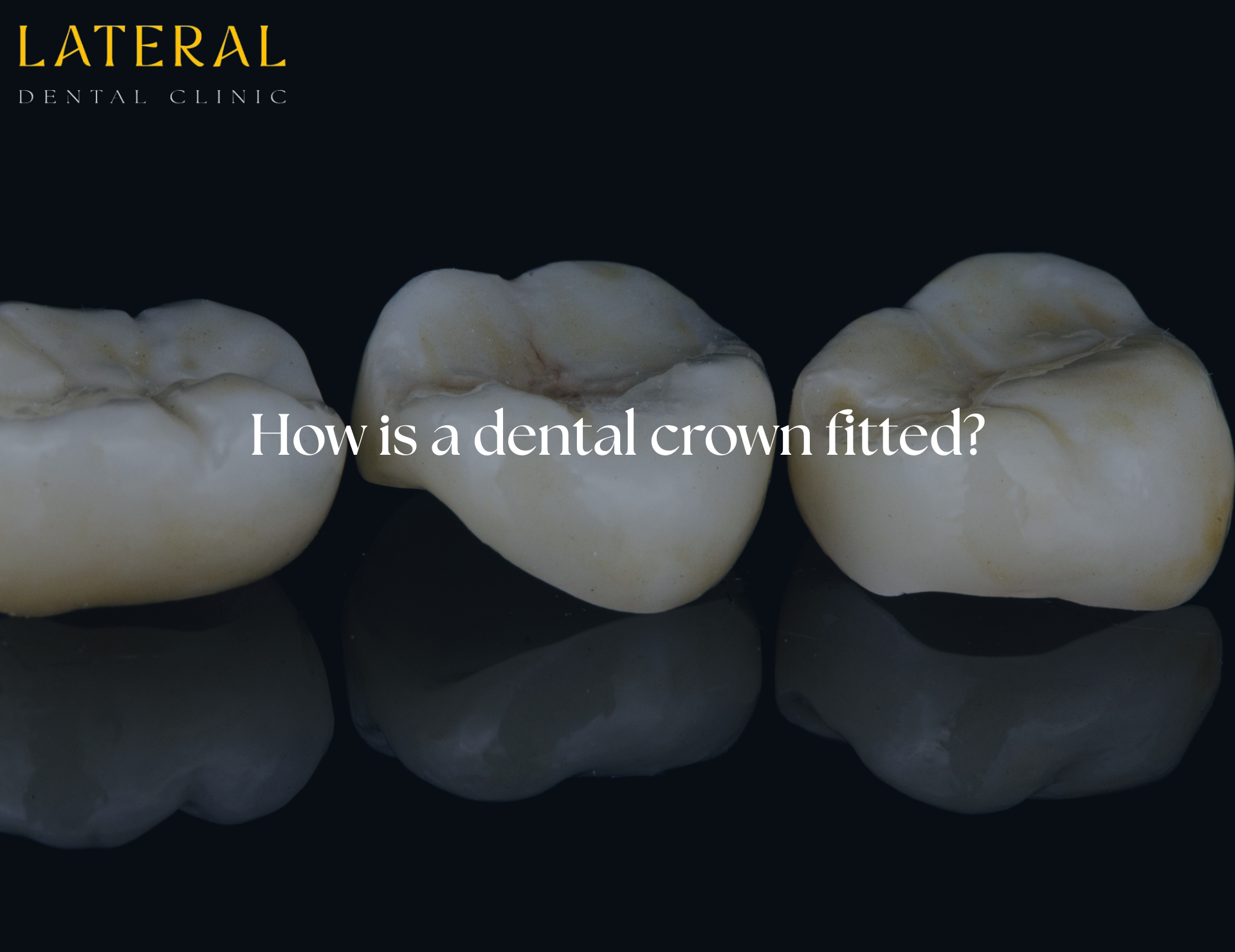 How Is a Dental Crown Fitted? Step-by-Step Guide